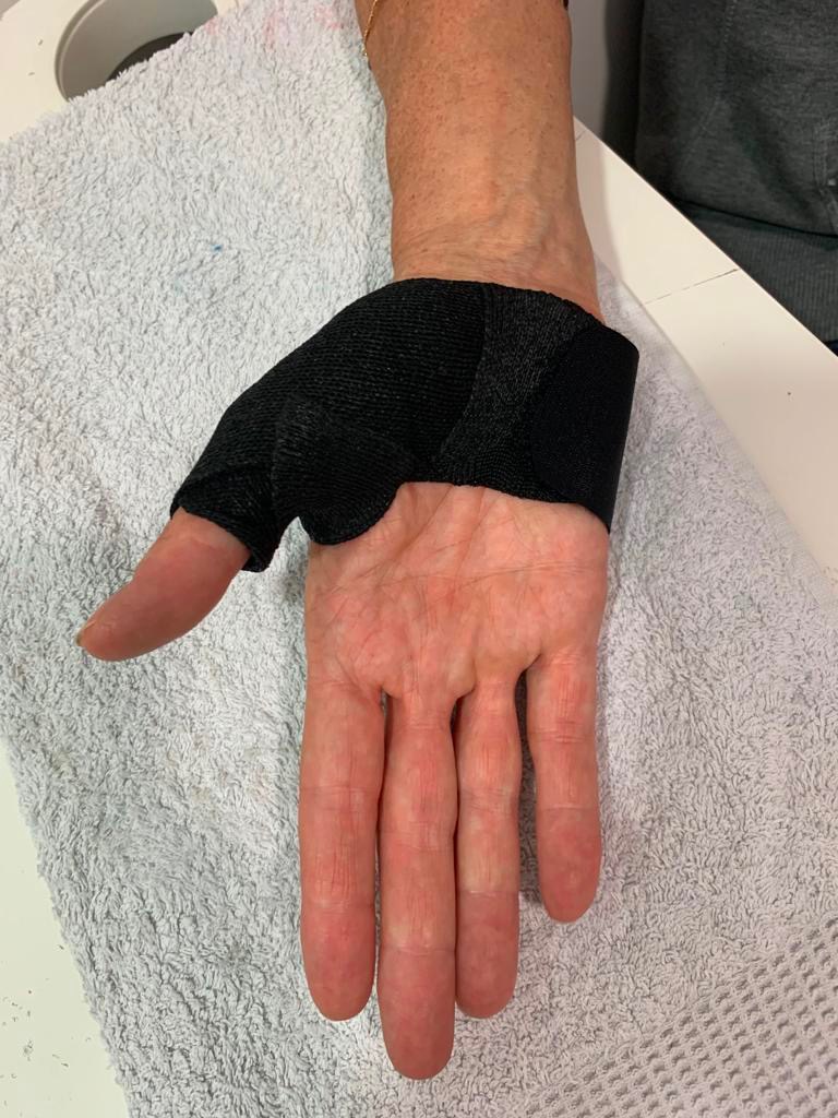 Gantelet syndactylie doigt – Aix Orthèses